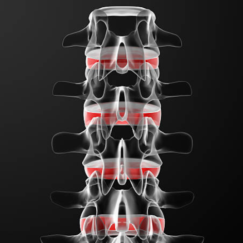 Nyaki gerincsérv - Fájdalom Központ